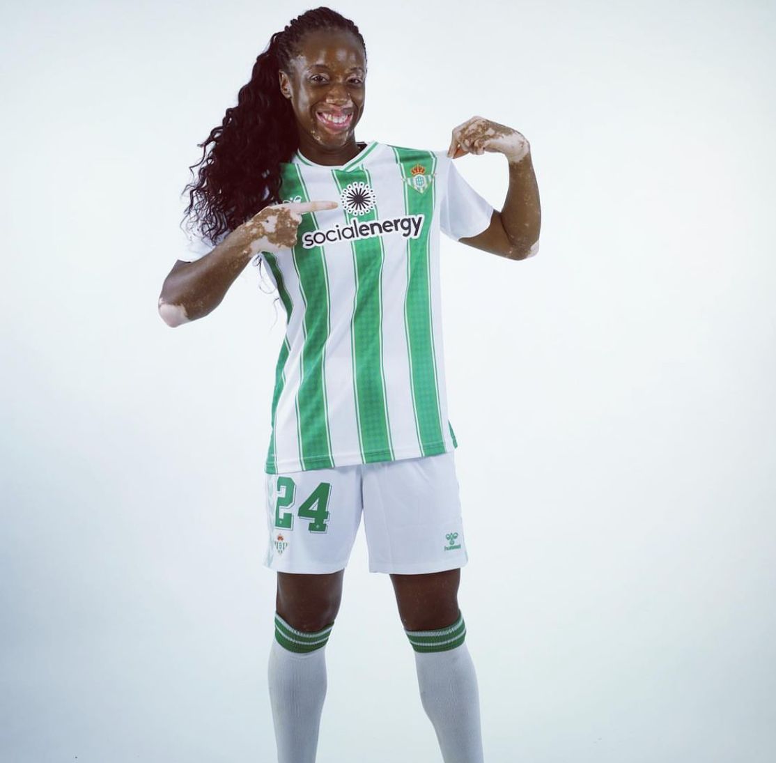 Tiffany Cameron proud to represent vitiligo community in EA FC